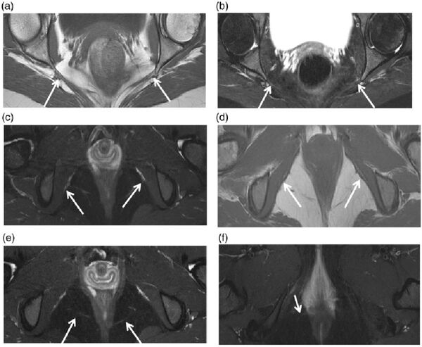 Pudendal Neuralgia - WikiSM (Sports Medicine Wiki)