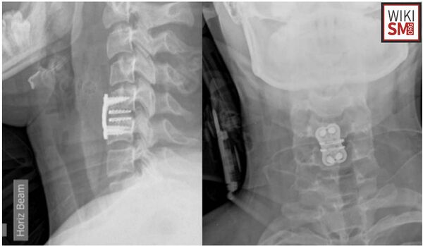 Cervical Teardrop Fracture - WikiSM (Sports Medicine Wiki)