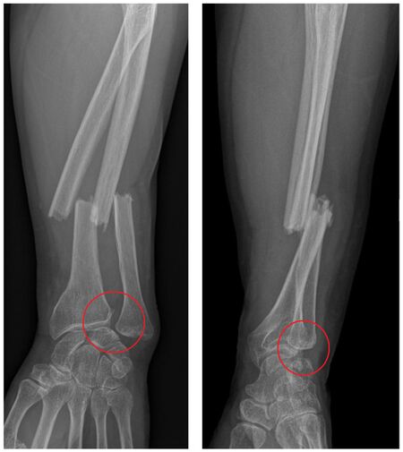 Distal Radioulnar Joint Dislocation - WikiSM (Sports Medicine Wiki)